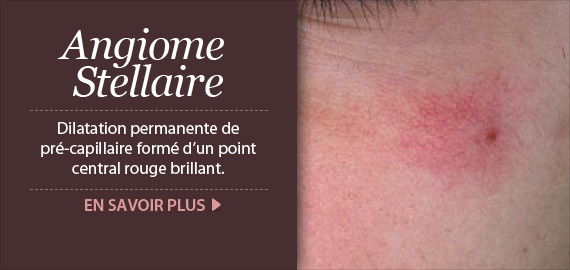 Thermocoagulation | Élimination d’Anomalies Cutanées