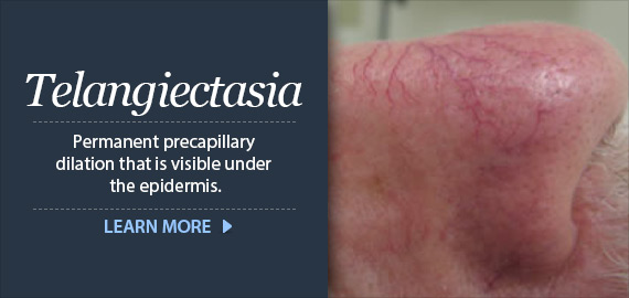 Thermocoagulation | Unwanted Skin Imperfections Removal | Remodella